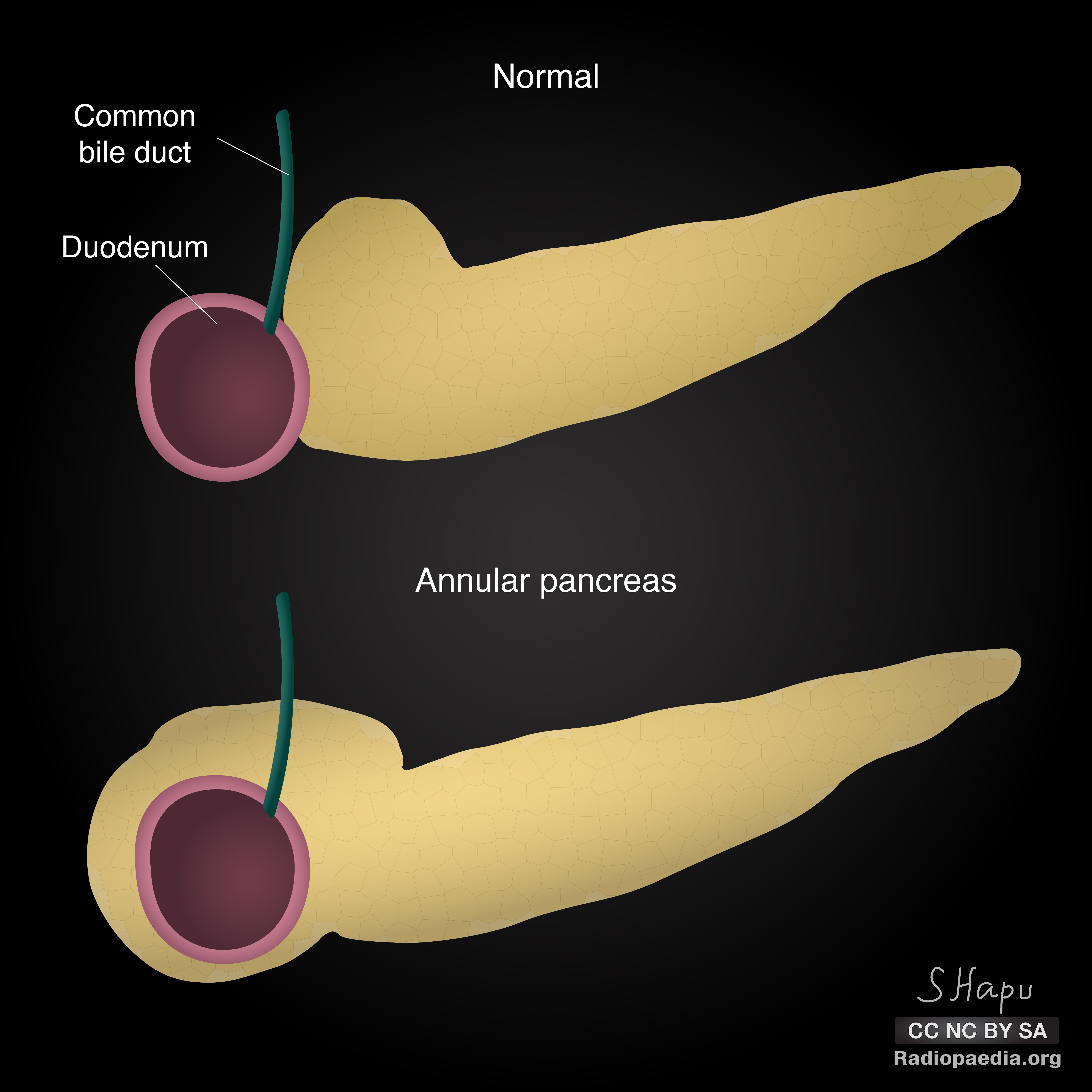 Radiopaedia Drawing Annular Pancreas English Labels Anatomytool